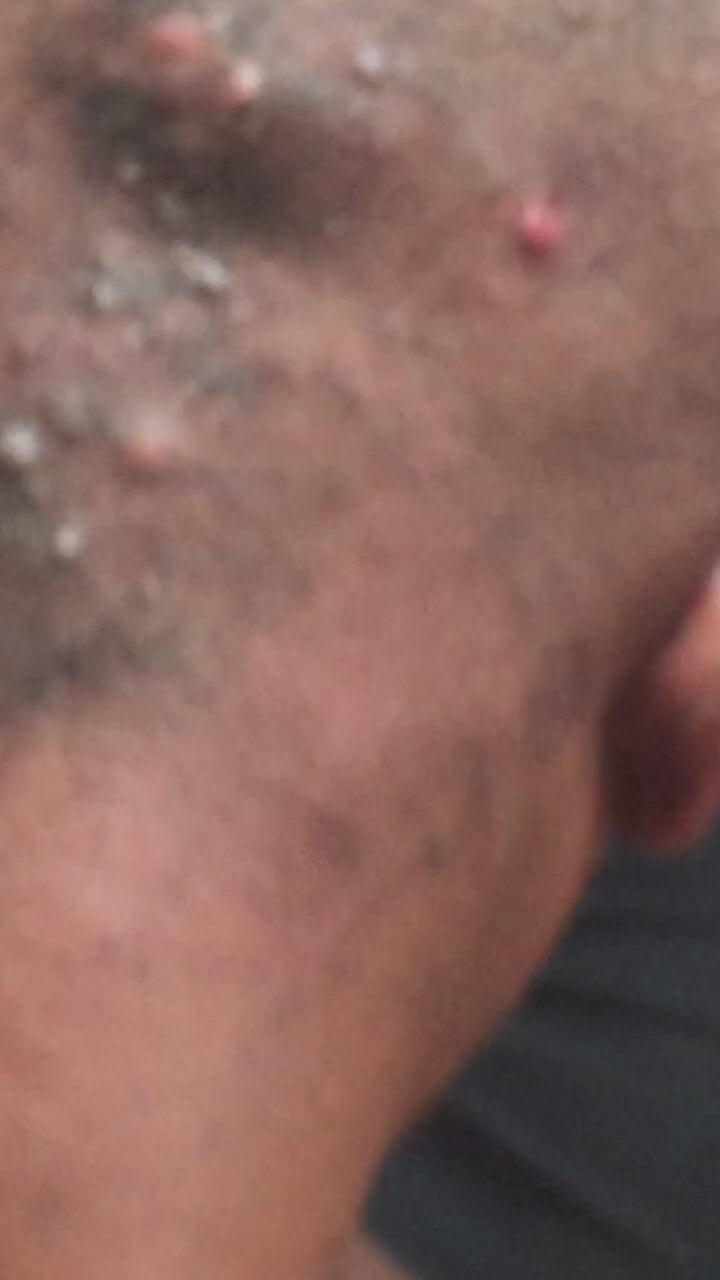 Bump Remover Spray | Bump Treatment Spray | Barber Bumps Store